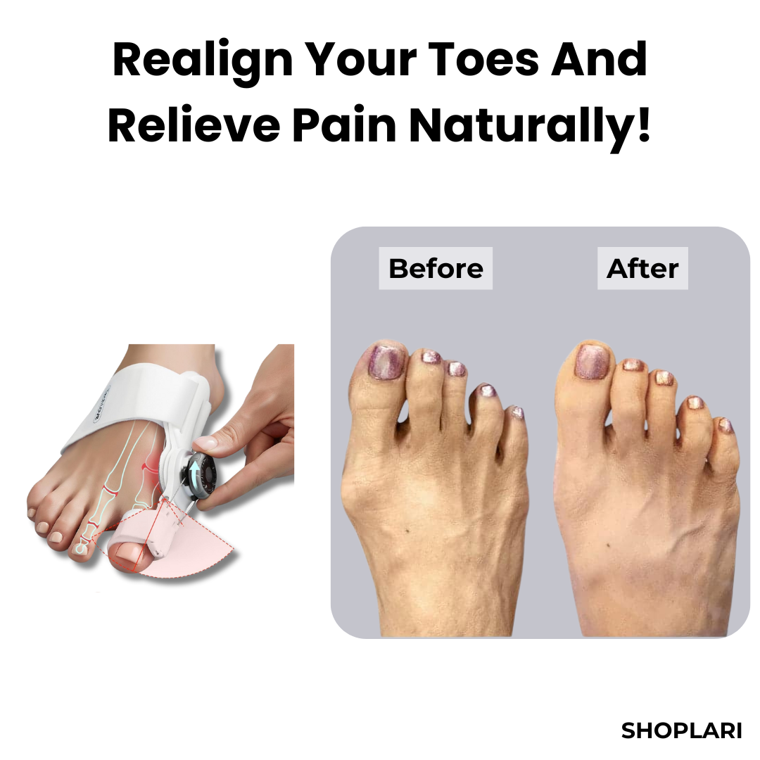 Last Day 50% OFF | ToeAlign™ Corrector for Hallux Valgus – Shoplari